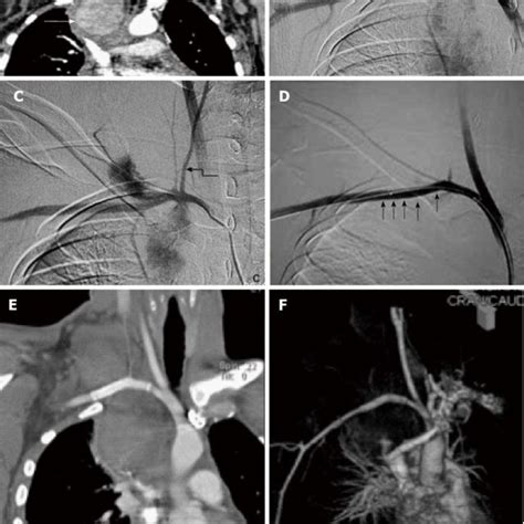 Prophylactic Embolization Of Right Hepatic Artery In High Grade Liver Download Scientific