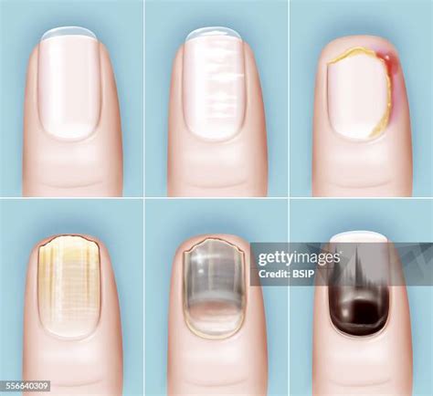Pathology Of The Nail Drawing Illustration Of The Various Nail