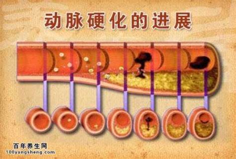 颈部动脉有斑块挂哪个科 颈部动脉斑块 随意云