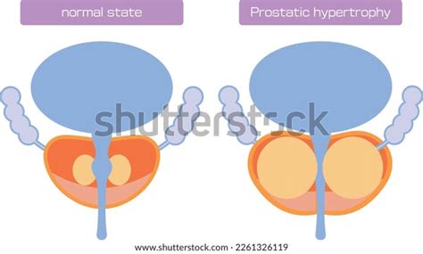 Illustration Benign Prostatic Hyperplasia Stock Vector Royalty Free