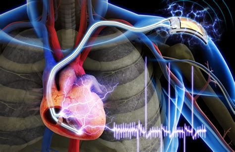 Piezoelectric Nano Device Powers Heart Rhythm Piezoelectric Nano Device Powers Heart Rhythm