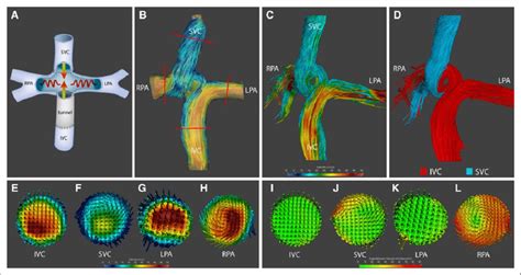 Visualization Of Abnormal Blood Flow Patterns In The Tcpc With 4d Mri