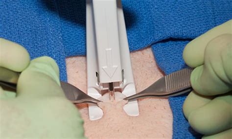Staples Hip Replacement Surgery