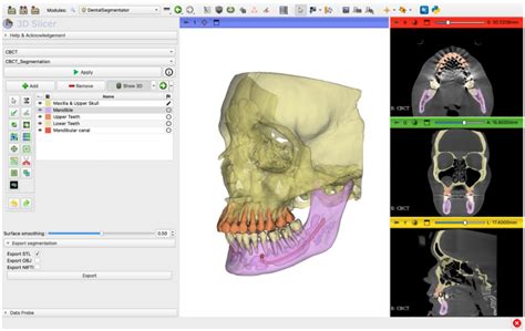 one click dental segmentation in 3d slicer with the dental segmentator