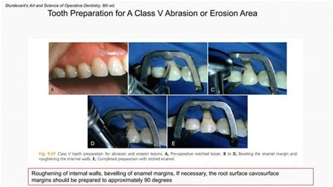 Class 5 Cavity Designs Pdf Dental Health Diseases And Conditions