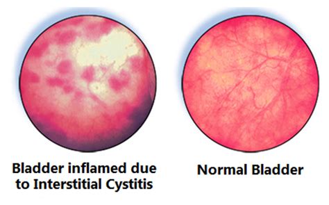 Root Causes Of Interstitial Cystitis Flares
