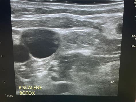 Shueh Hao Lim On Linkedin Anterior Scalene Botox Injection For Neurogenic Thoracic Outlet Syndrome…