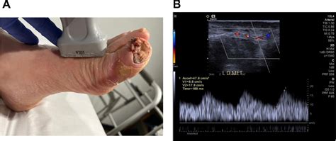 Hybrid Superficial Venous Arterialization And Endovascular Deep Venous