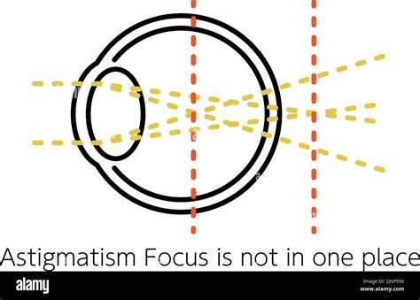 Medical Illustration Of Visual Acuity And Refractive Error Astigmatism Not In Focus In One