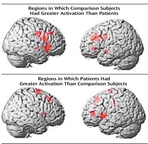 Hypofrontality And Hyperfrontality During Twoback Working Memory Task Download Scientific Hypofrontality And Hyperfrontality During Twoback Working Memory Task Download Scientific