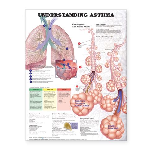 Understanding Asthma Chart 52x70cm With Special Rigid Lamination And Plastic Rollers