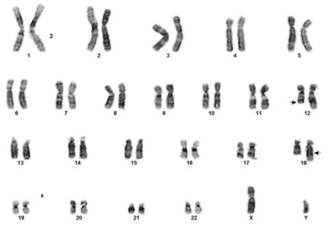 Presence Of A T 12 18 Q14 Q21 Chromosome Translocation And Fusion Of The Genes For High