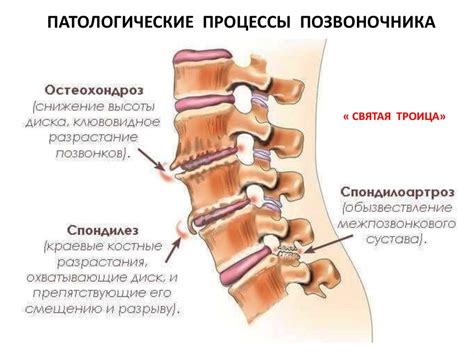 Циркулярные протрузии межпозвонковых дисков задняя циркулярно дорсальная поясничного отдела