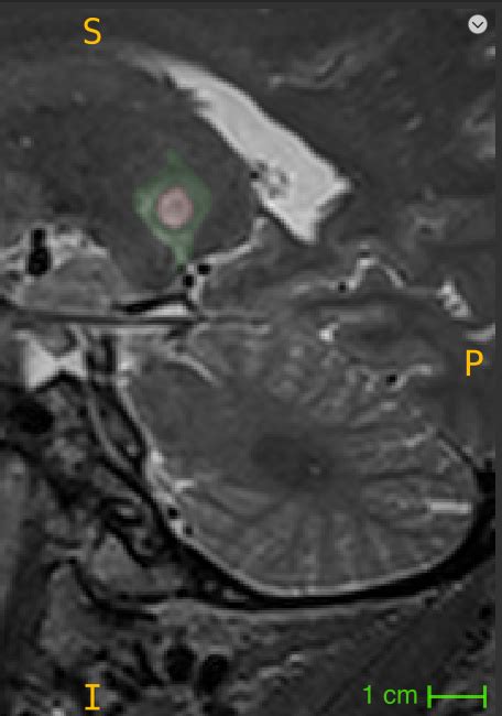 Resample To Same Spacing And Size And Align To Same Origin Page 2 Beginner Questions Itk