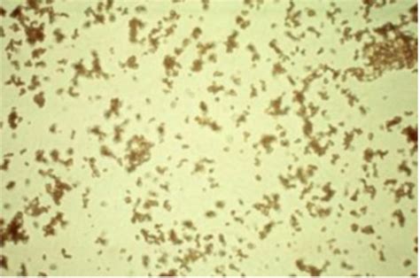 Amorphous Urates In Urine