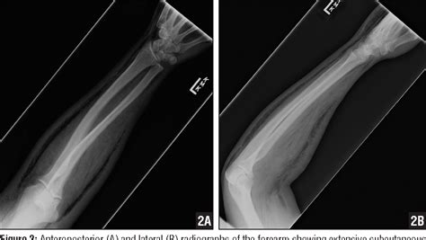 Figure 1 From Extensive Subcutaneous Emphysema Resembling Necrotizing