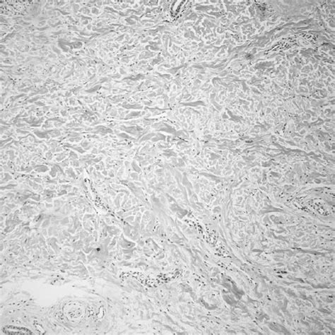 Magnetic Resonance Imaging Showed Fusiform Soft Tissue Swelling Around Download Scientific