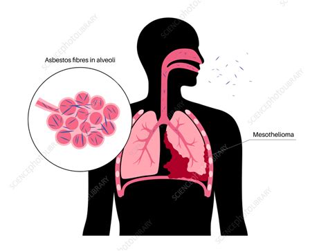 Mesothelioma Cancer Disease Illustration Stock Image F0419632