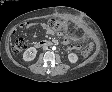 Mesentery With Inflammation Involving The Left Side Of Abdomen Small