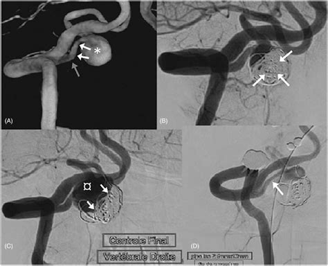 A 3d Angiographic Reconstruction Anterior View Of The Right Download Scientific Diagram