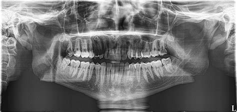 My Upper Right Wisdom Tooth Is Cracked In Half Rdentistry