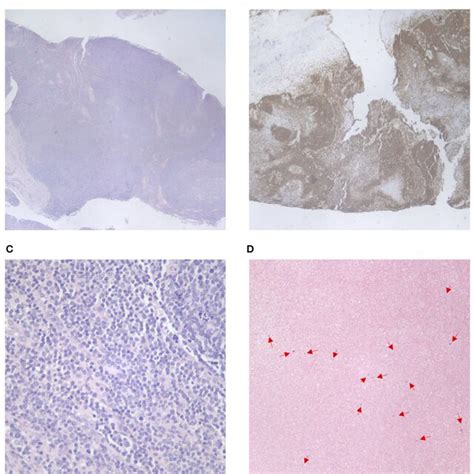 Cervical Lymph Node Pathology A Effacement Of Lymph Node Download Scientific Diagram