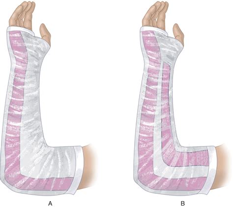 Sugar Tong Splint Ankle At Maria Baum Blog