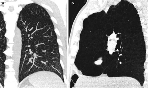 Diffuse Lung Diseases Radiology Key