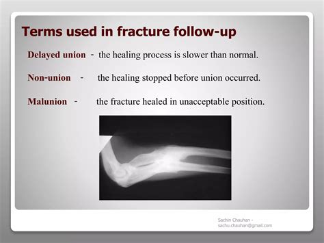 Fracture Types Complications And Management Pptx