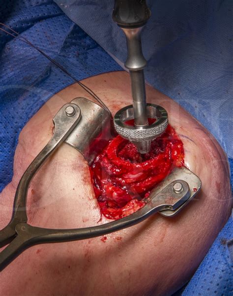 Total Shoulder Replacement Lima Smr Stemless Reverse Shoulder Surgical