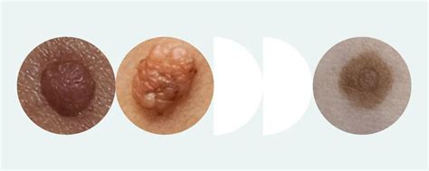 7 Melanoma Symptoms Plus Images To Watch For