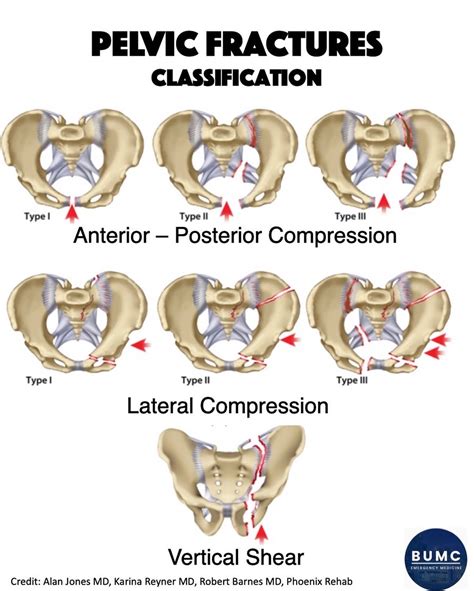 Pelvic Fractures 1 Youtube
