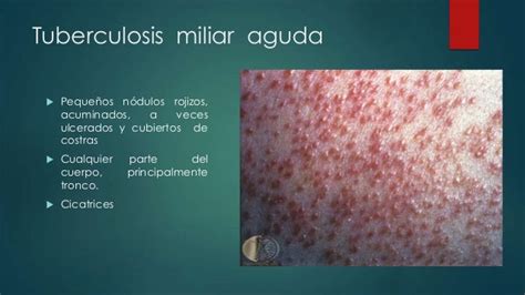 Tuberculosis Cutanea