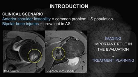 Fully Automated Mri Bone Segmentation Of Glenoid And Humeral Head