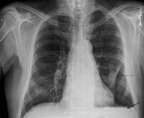 Hydropneumothorax And Trapped Lung Journal Of Emergency Medicine