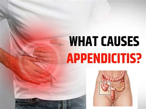 Appendicitis Can Cause Blockage In Blood Flow 7 Causes Of This