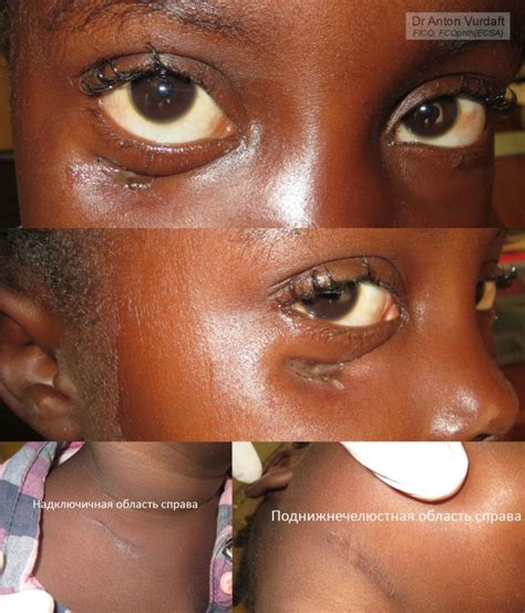 Scrofuloderma Tuberculous Cold Abscess Tuberculous Periostitis Tuberculous Osteomyelitis