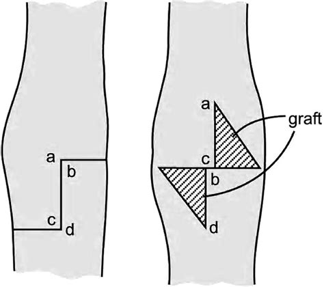 Partial Z Plasty With 90° Angles Download Scientific Diagram
