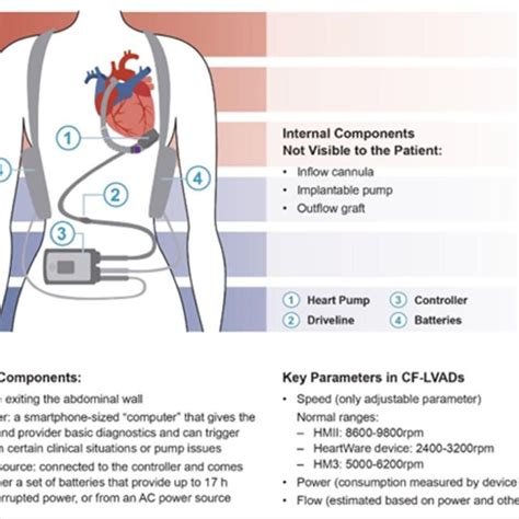 Components Of Contemporary Left Ventricular Assist Devices This Figure Download Scientific
