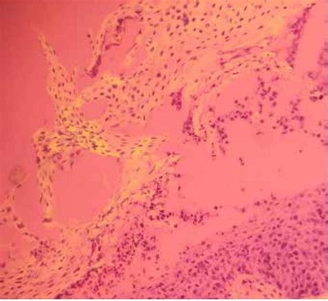 Thickened Epidermis Acanthosis Parakeratosis Granular Layer Present