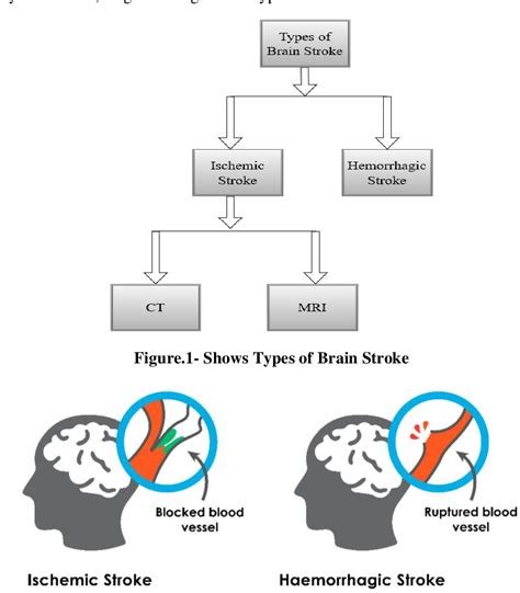 Figure 2 From Analyzing Existing Algorithms And Identifying Gaps In Brain Stroke Detection
