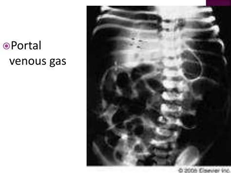 Necrotizing Enterocolitis 1shri Ppt