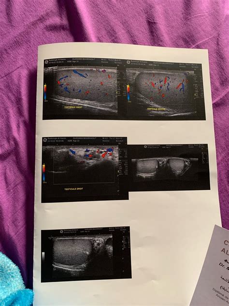 Does This Look Like Varicocele Rvaricocele