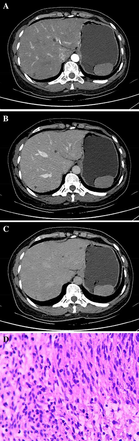 A 46 Year Old Female With Low Risk Gist In The Stomach The Enhanced Ct Download Scientific