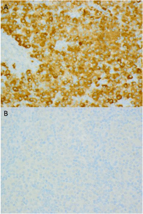 Kappa Lambda 20 × The Lymph Node Infiltrate Demonstrated Download Scientific Diagram