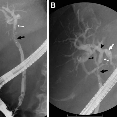 Ercp Demonstrated An Irregular Stricture Of The Hilar Bile Duct In A Download Scientific