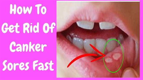 Fun Info About How To Get Rid Of Canker Sores On Tongue Japansad