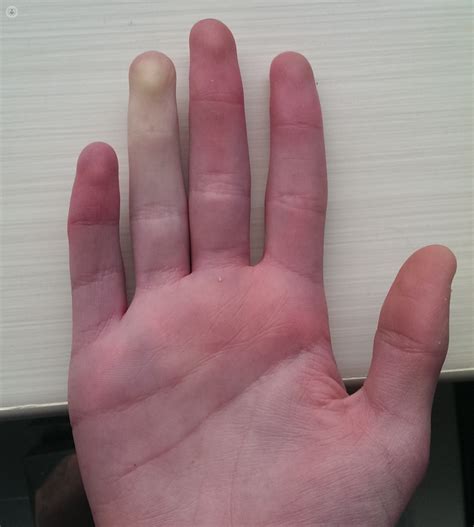 Enfermedad De Raynaud Qué Es Síntomas Y Tratamiento Top Doctors
