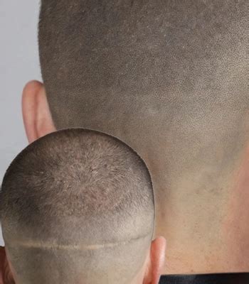 Smp Scar Camouflage Melbourne Fue And Fut Hair Transplant Scars