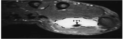 Nodular Fasciitis Of The Hand A Case Report Clinical Orthopaedics And Related Research®